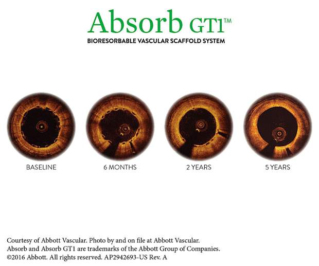 First-of-its-kind, naturally dissolving heart stent now available in ...